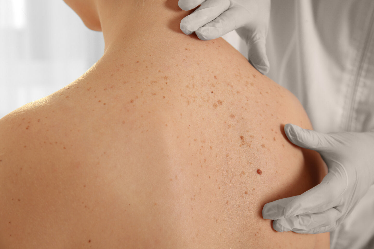 The Importance of Skin Checks and Screenings: Preventing Skin Cancer ...