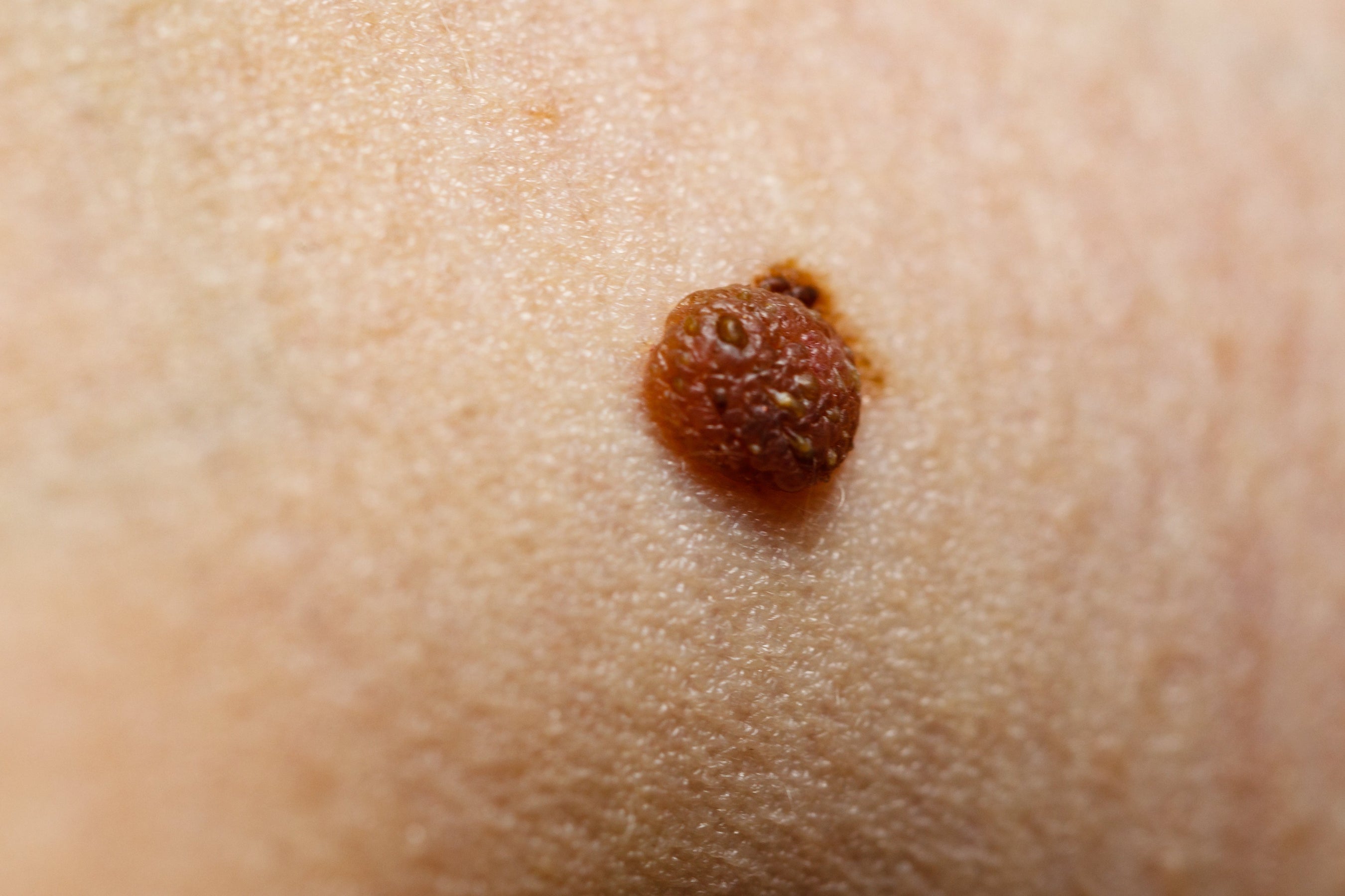 Understanding the ‘ABCDE’ Rule for Melanoma: A Simple Guide to Early D ...
